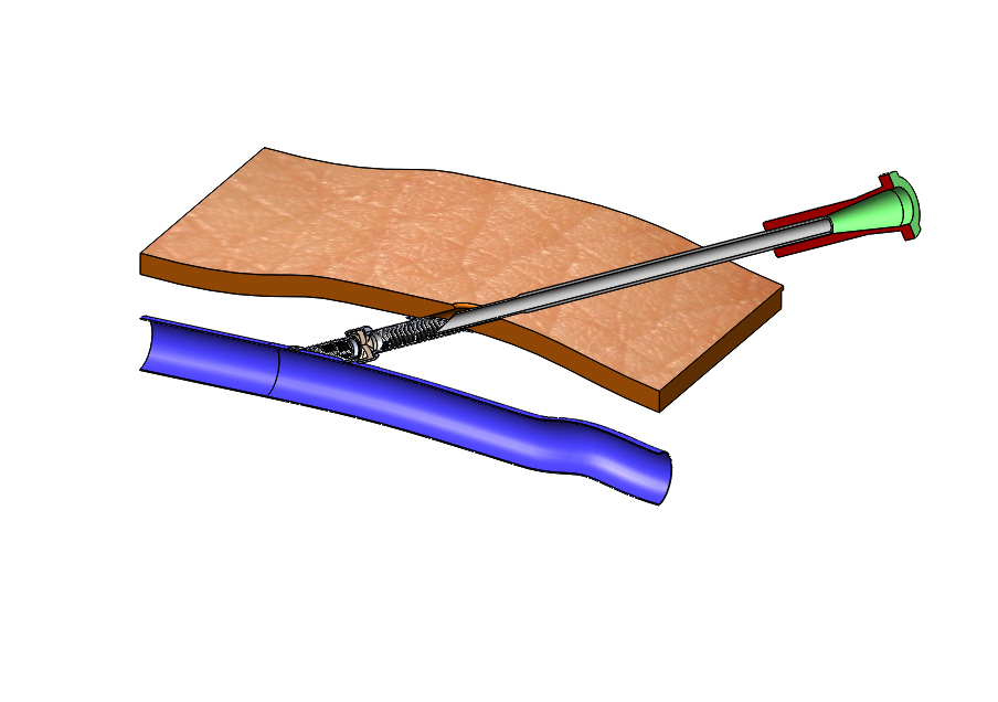 Access 4 Life -Implant Prototype - Blank innovations